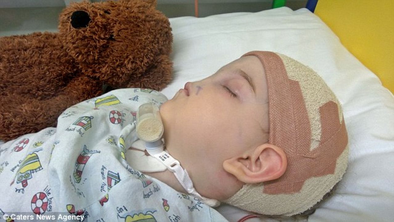 Una niña que nació sin nariz se somete al primer implante nasal con una ...