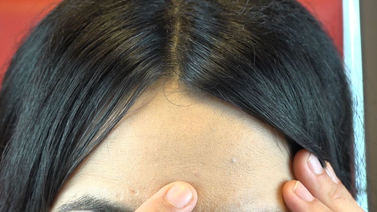Cómo tratar el acné en adultos de forma sencilla