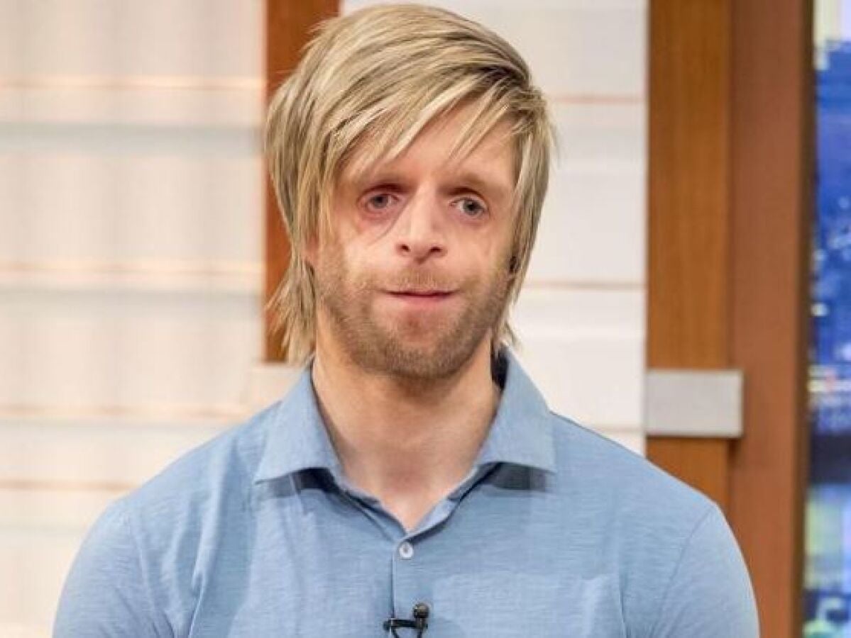 Síndrome De Treacher Collins Antes Y Después