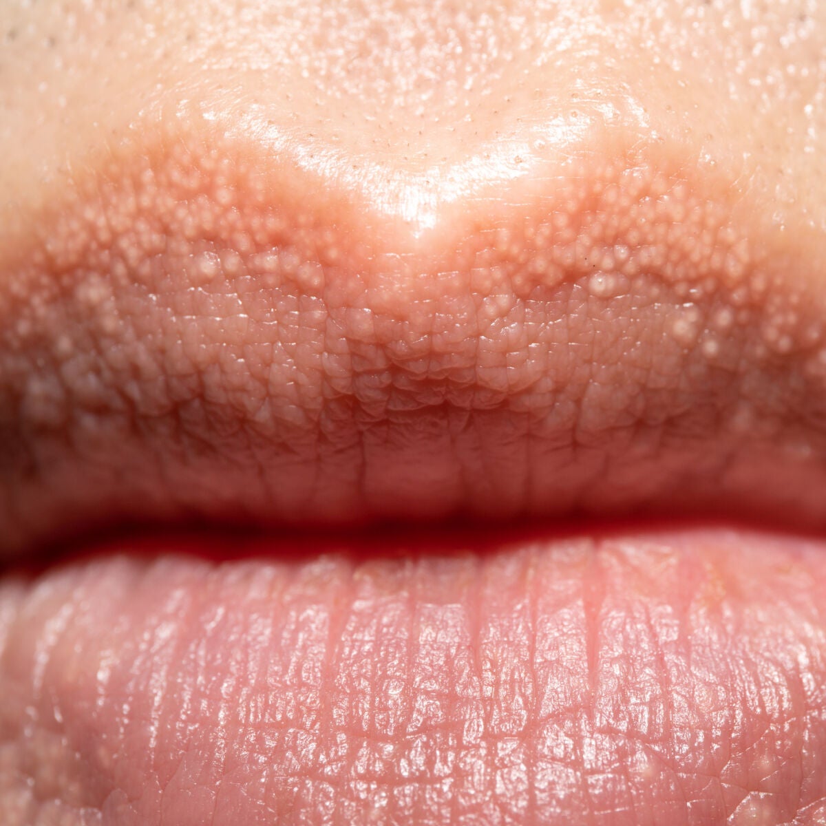 Glándulas Sebáceas En Los Labios