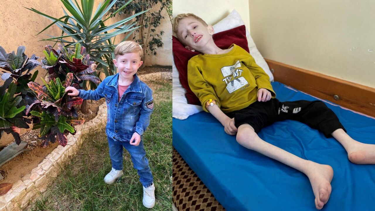 La grave situación de hambruna en Gaza en imágenes: Fadi tiene 6 años ...