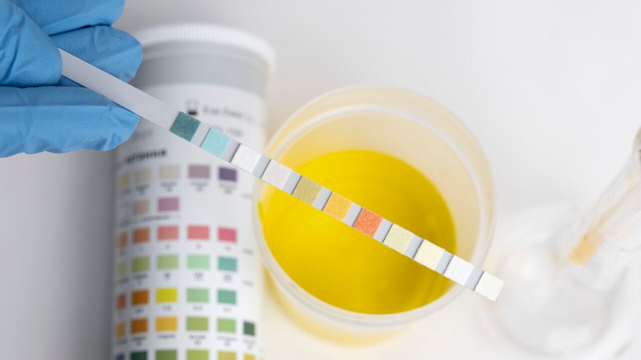 Naranja, azul o marrón: qué dice el color de la orina sobre tu salud