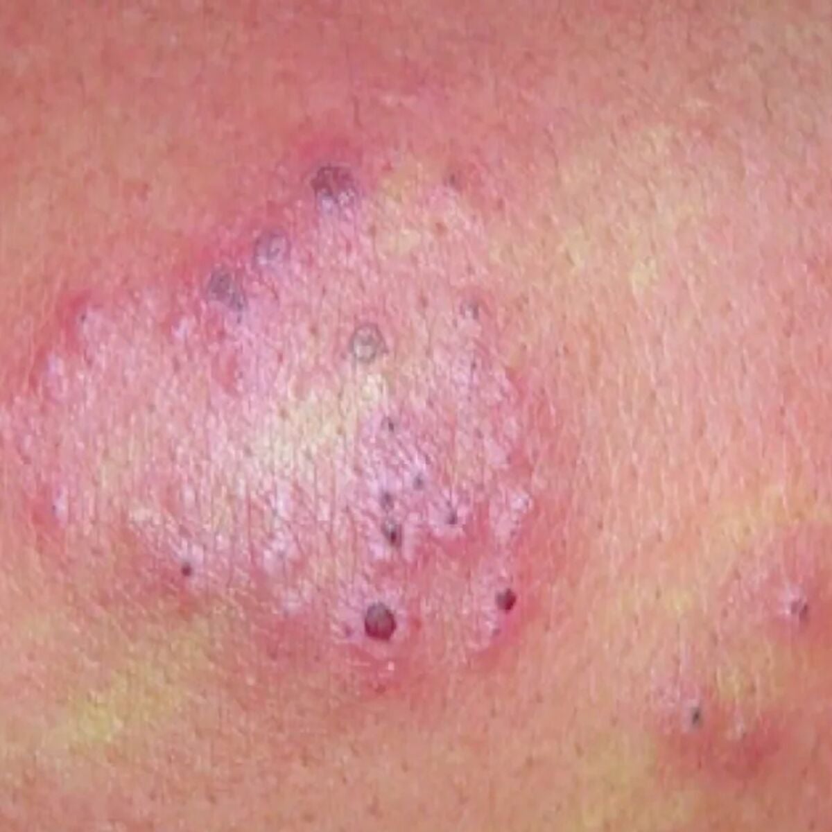 Herpes Zoster Vesiculas Oftalmicas