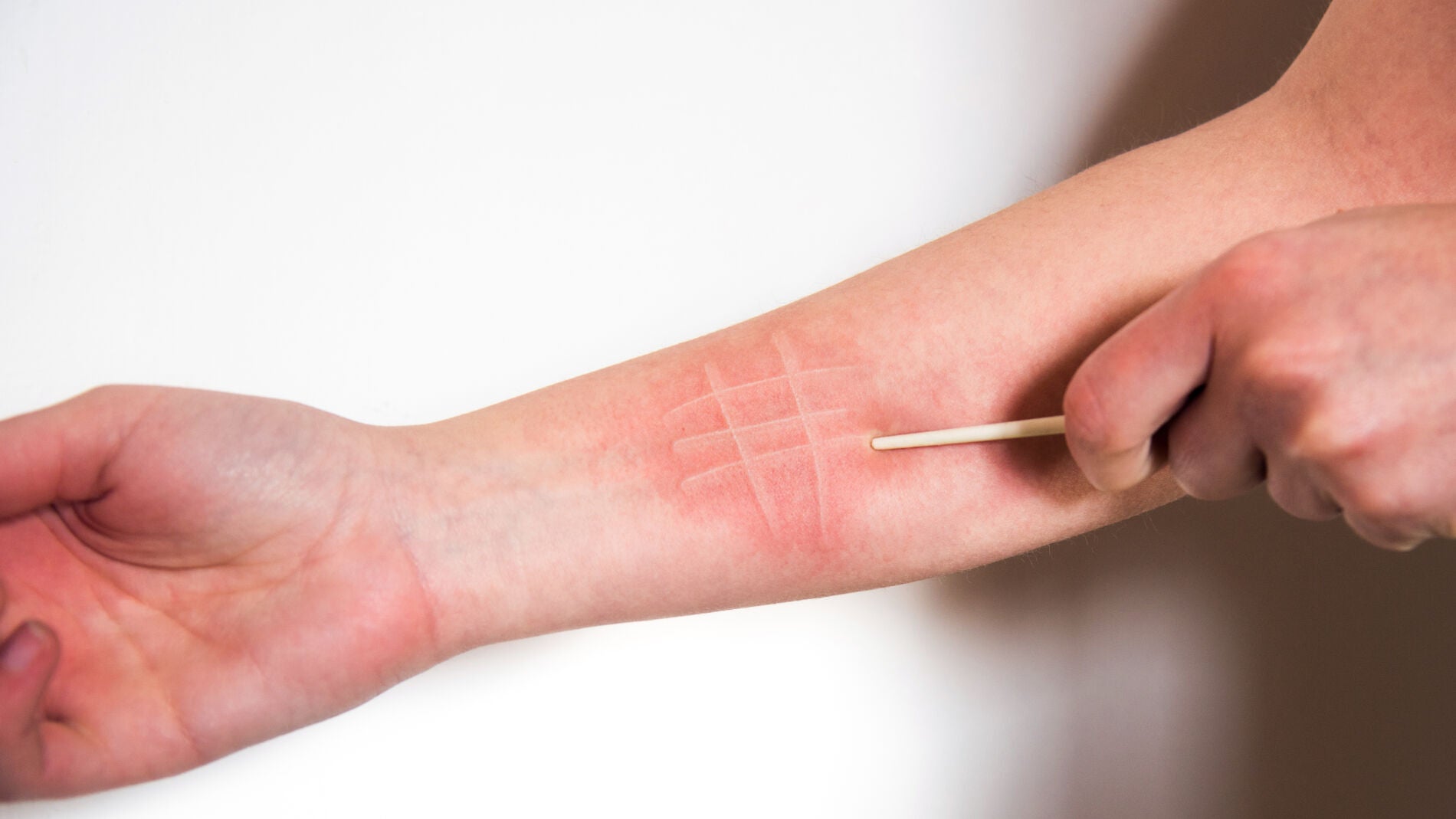 ¿Qué es el dermografismo? El trastorno con el que puedes "escribir ...