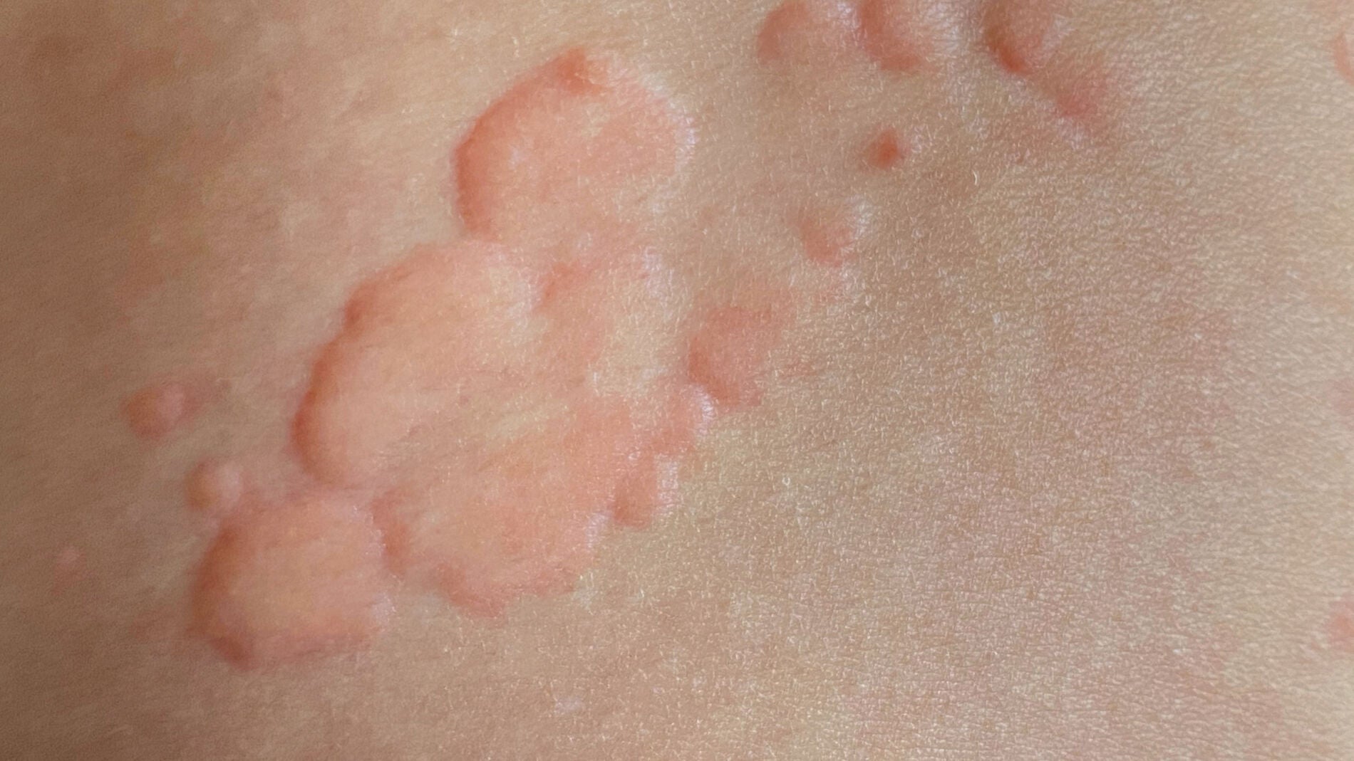 Liquen plano: ¿En qué consiste este problema de piel?