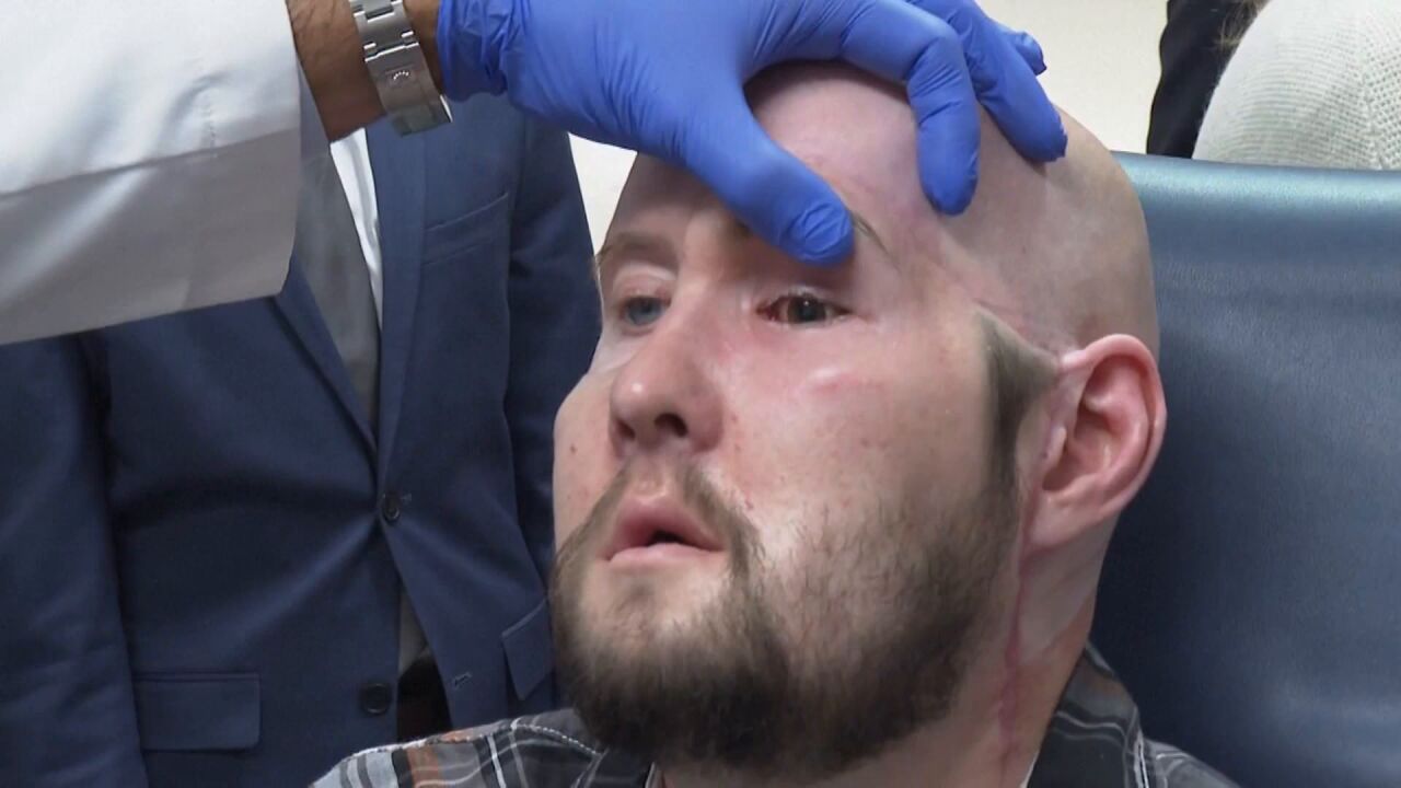 Trasplantan por primera vez un ojo entero a un paciente en una ...