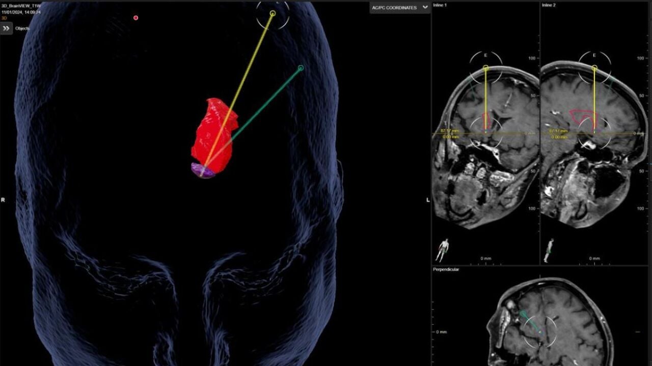 Una mujer de 51 años, primera paciente operada en Galicia para curarle ...