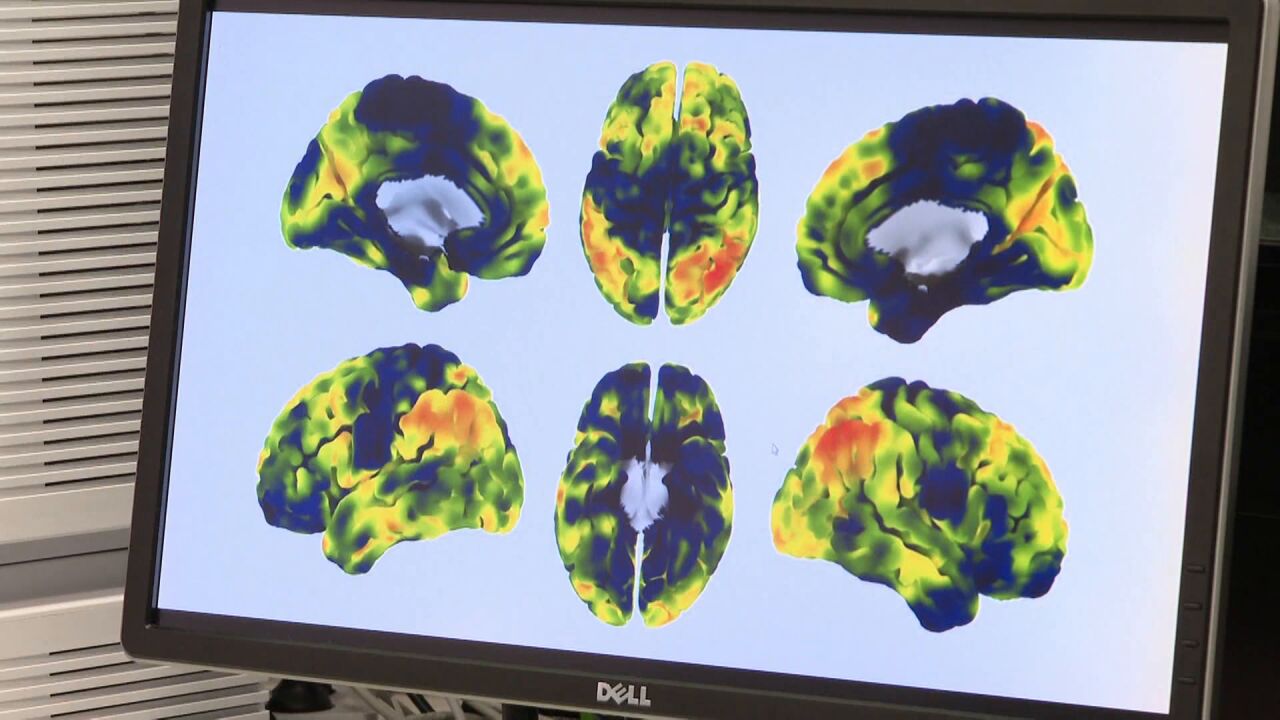 Un nuevo biomarcador permite identificar pacientes que desarrollarán ...